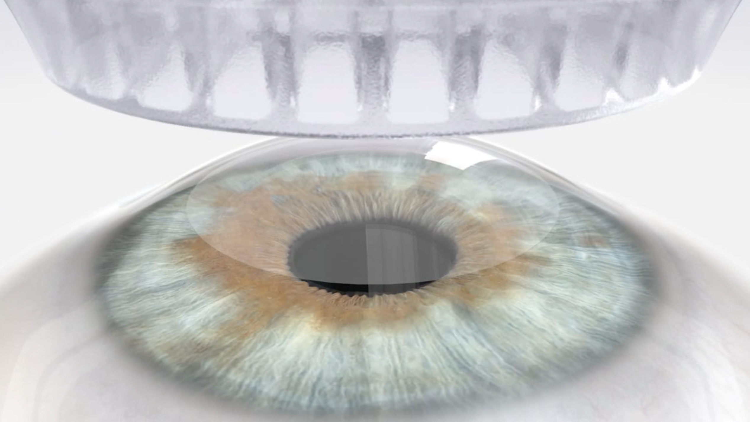 SMILE Vision Correction - 清晰眼科 | Clarity Eye Centre